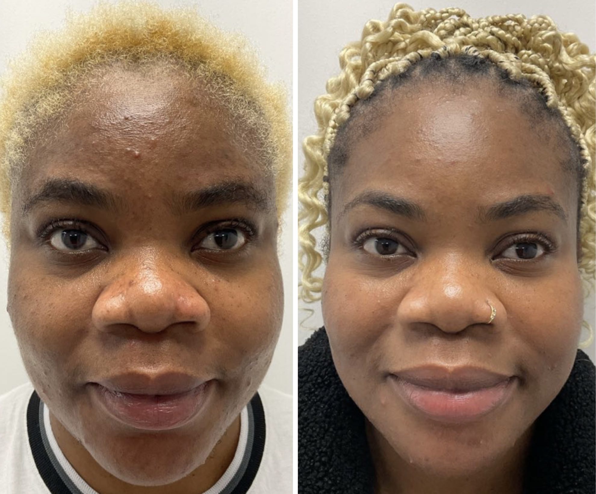 Body Pigmentation Peel – FeonixAesthetics