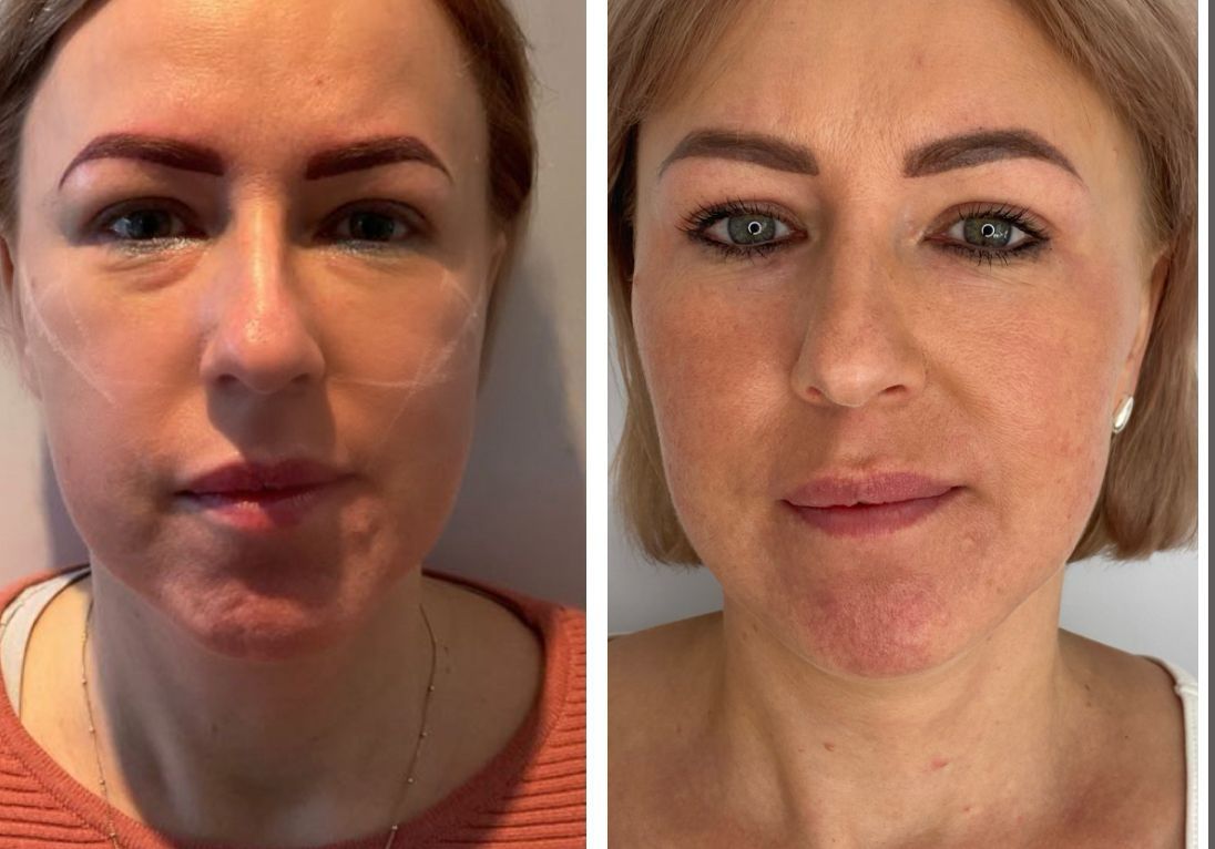 Cheek Enhancements – FeonixAesthetics