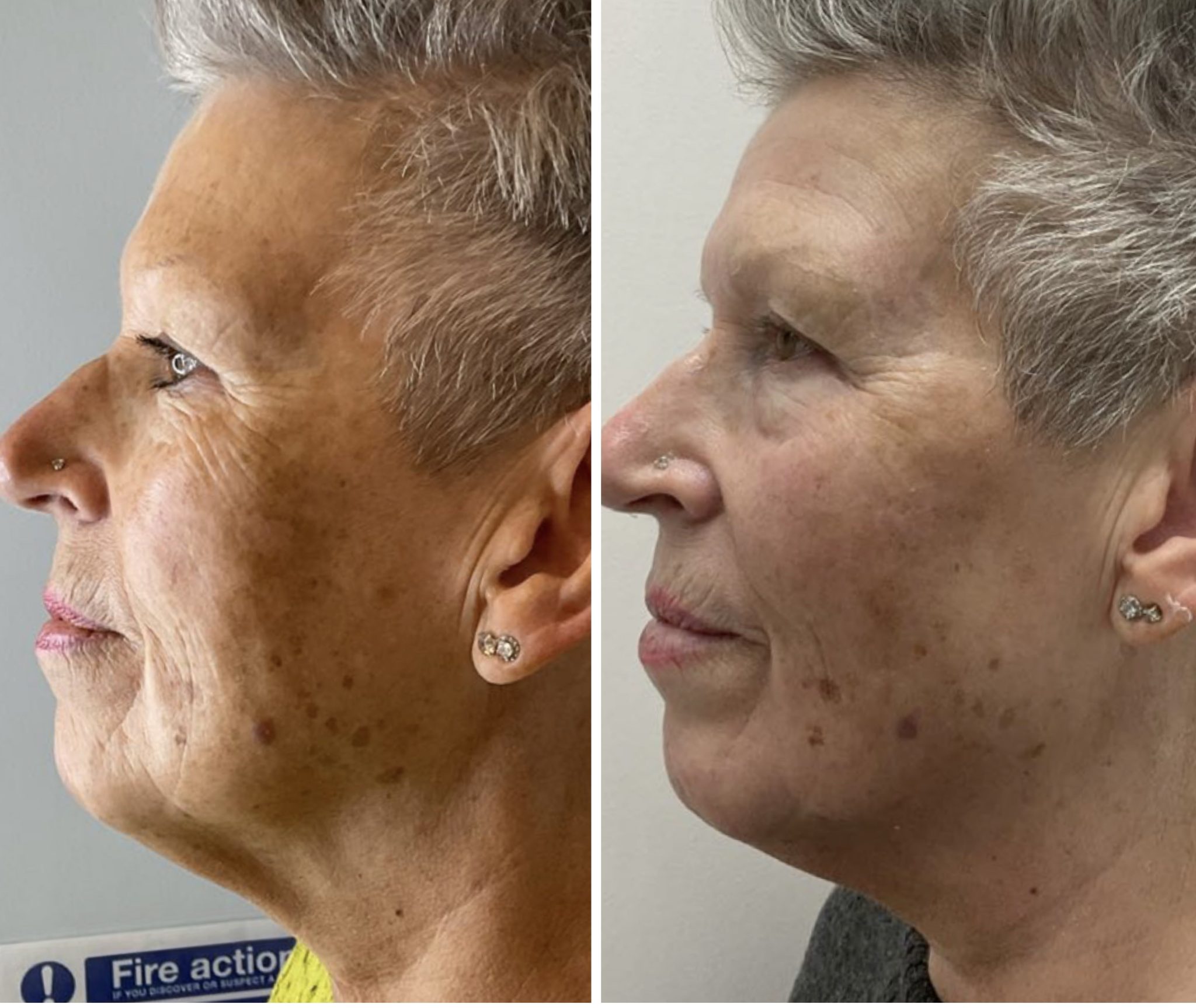 Body Pigmentation Peel – FeonixAesthetics