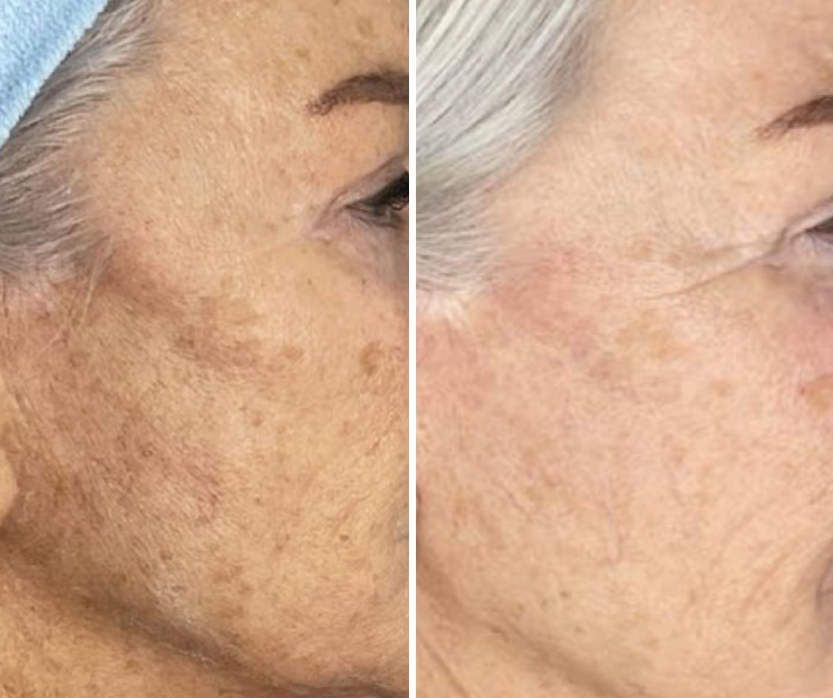 Body Pigmentation Peel – FeonixAesthetics
